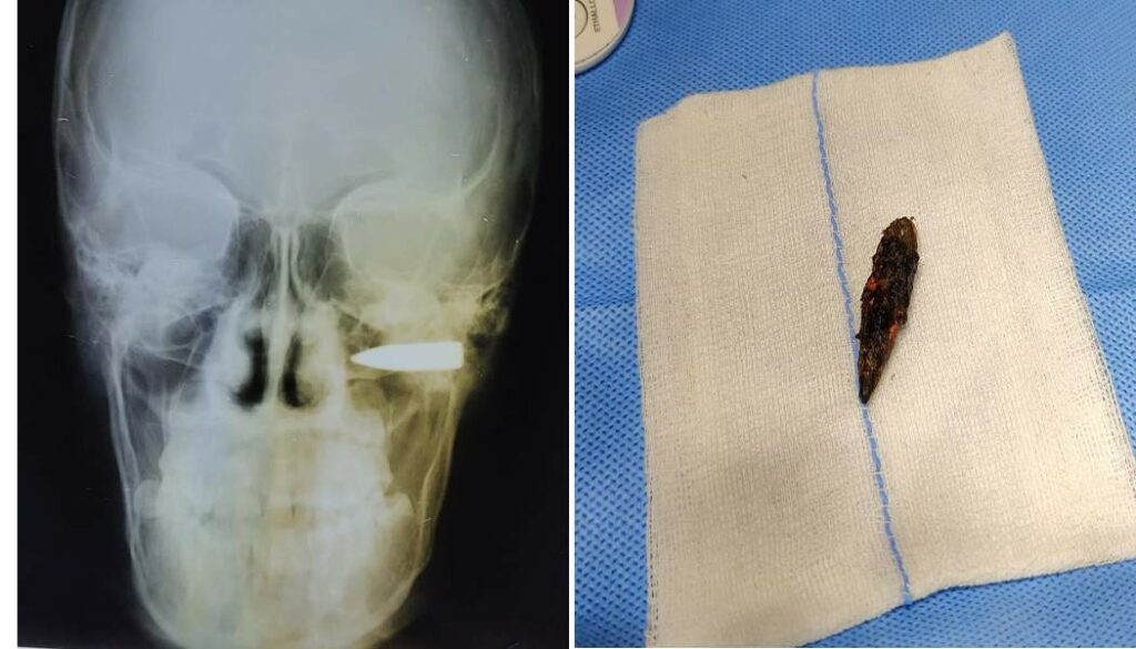 Doctors Successfully Extract Bullet Lodged in Left Ear in Complex ...