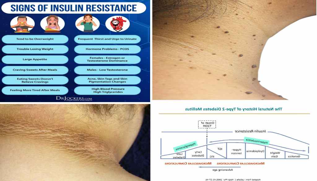 Revolutionary Approach Unveiled to Combat Insulin Resistance, Lower ...